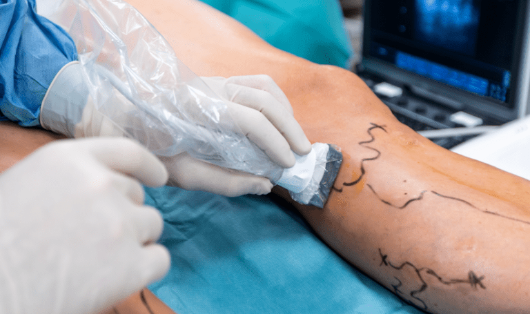 Vein Stripping And Ligation Surgery In Dubai Dr.Ashok Gupta
