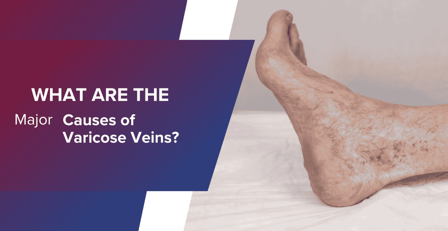 What Are The Major Causes Of Varicose Veins?