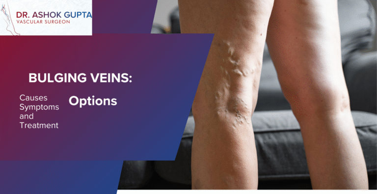 Why Are My Veins Popping Out? Guide To Leg Bulging Veins