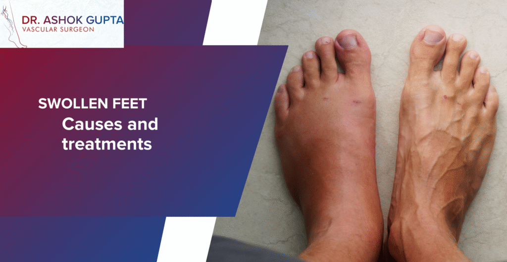 Swollen Feet: Causes And Treatments