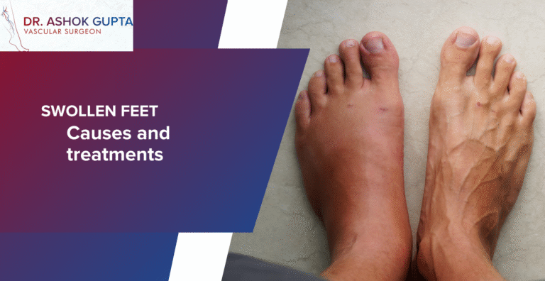 Swollen Feet: Causes And Treatments
