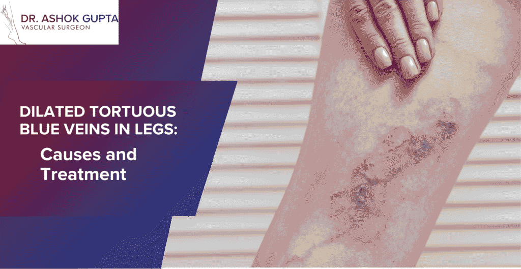 Dilated Tortuous Blue Veins In Legs: Causes And Treatment