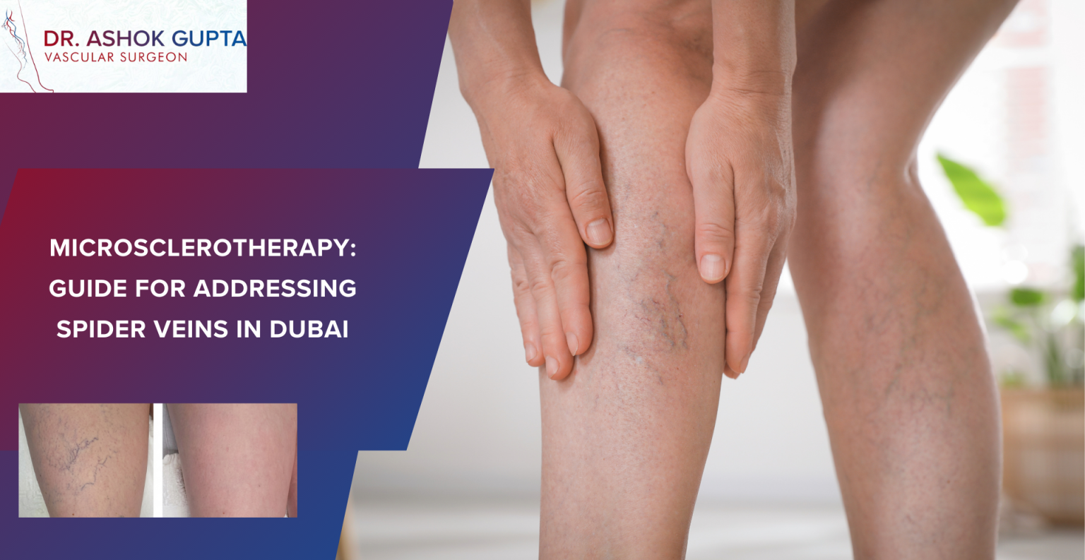 Why Are My Veins Popping Out? Guide To Leg Bulging Veins